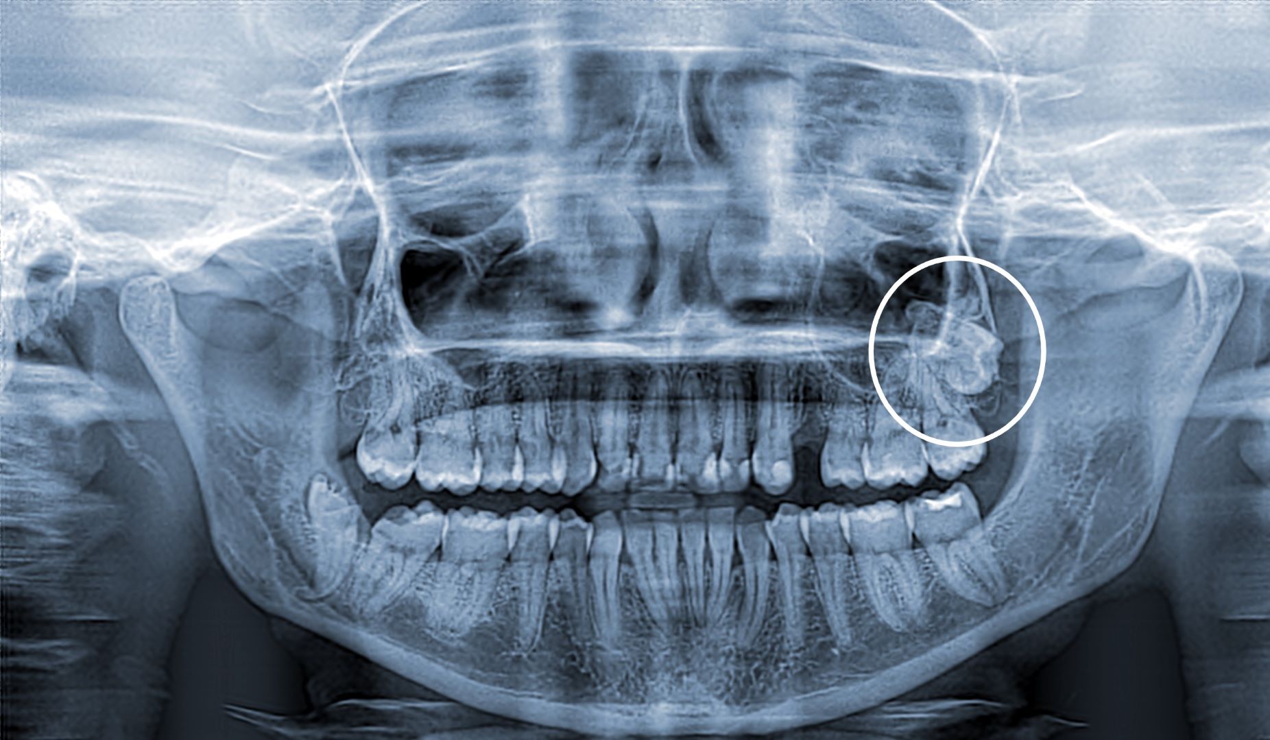 ¿TERCER MOLAR? DESCUBRE QUÉ ES Y COMO TRATARLO. - Atident